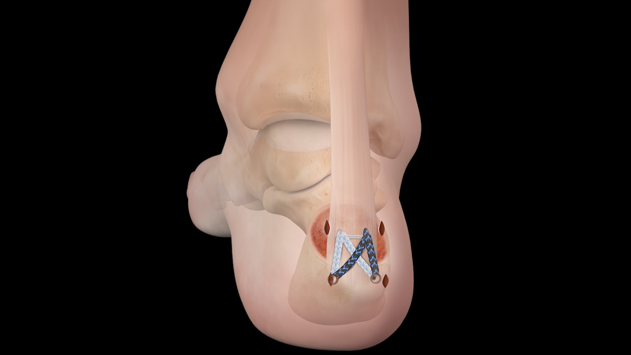 Arthrex - MIS Percutaneous Achilles SpeedBridge™ Surgical Technique