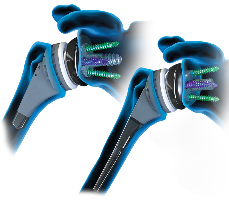 Arthrex - Univers Revers™ Total Shoulder System Arthrex - Univers Revers™ Total Shoulder System