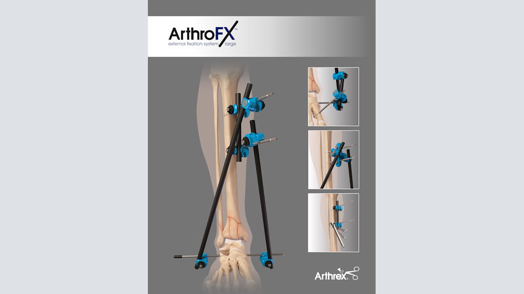 Arthrex Sistema De Manejo De Fracturas Para El Tobillo