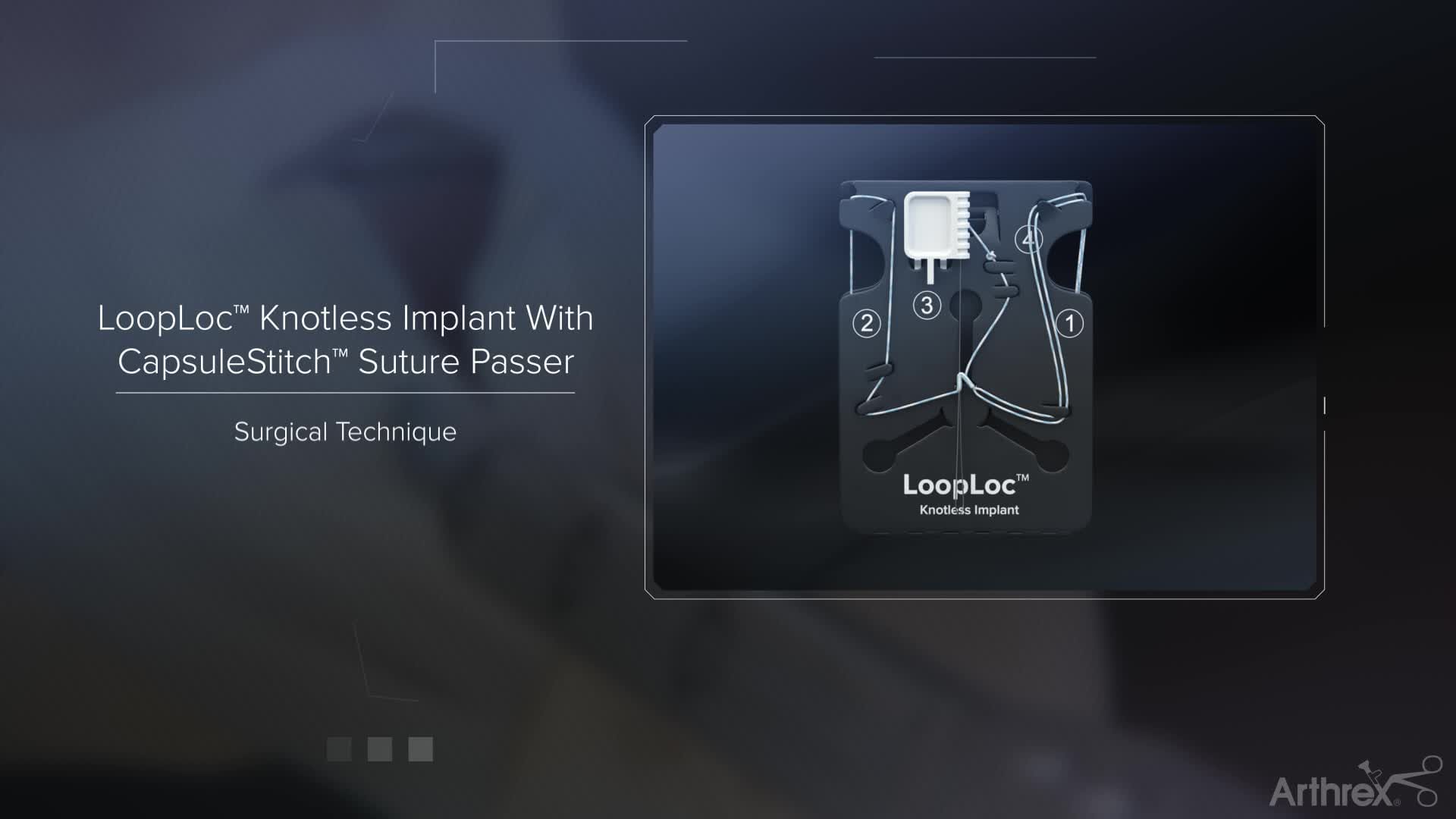 Arthrex Hip Capsular Closure Using Looploc™ Knotless Implant