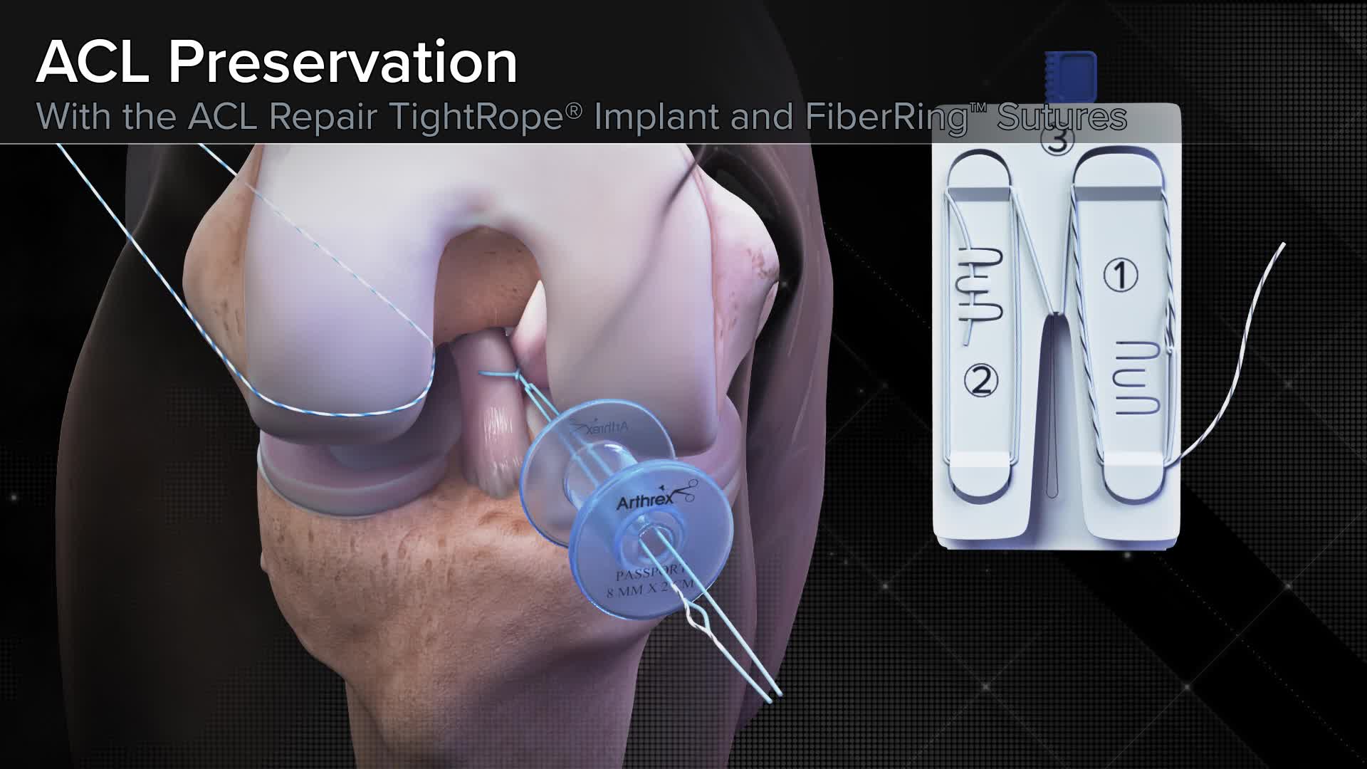 Arthrex - ACL Preservation With the ACL Repair TightRope® Implant and ... Arthrex - ACL Preservation With the ACL Repair TightRope® Implant and ...