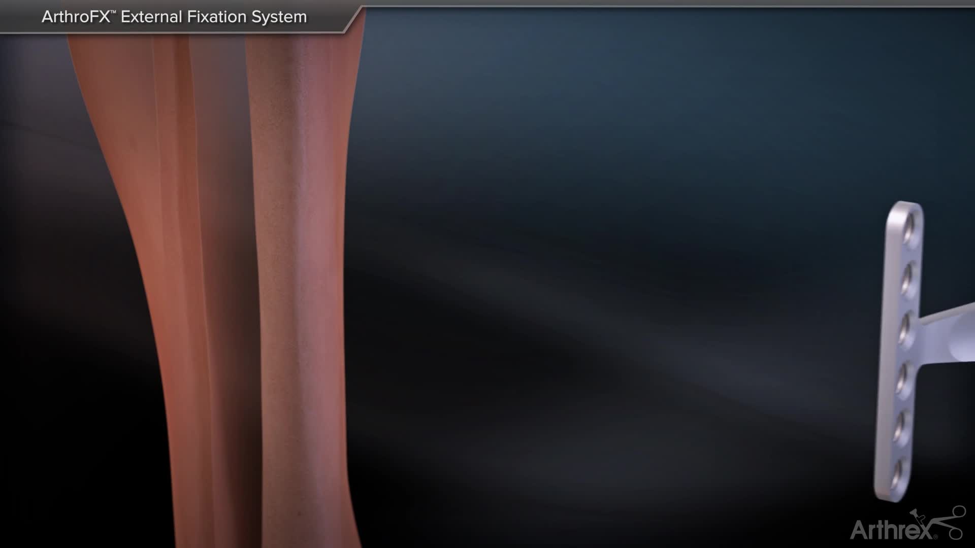 Arthrex Arthrofx™ External Fixation System