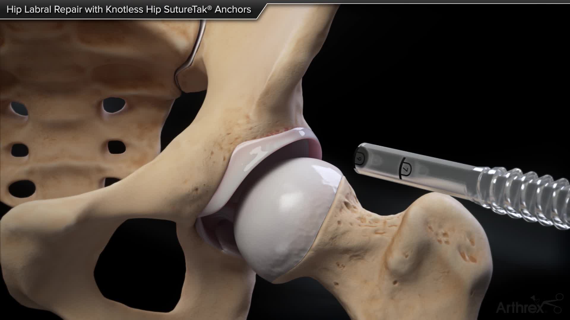 Arthrex Hip Labral Repair With Knotless Suturetak® Anchors Simple