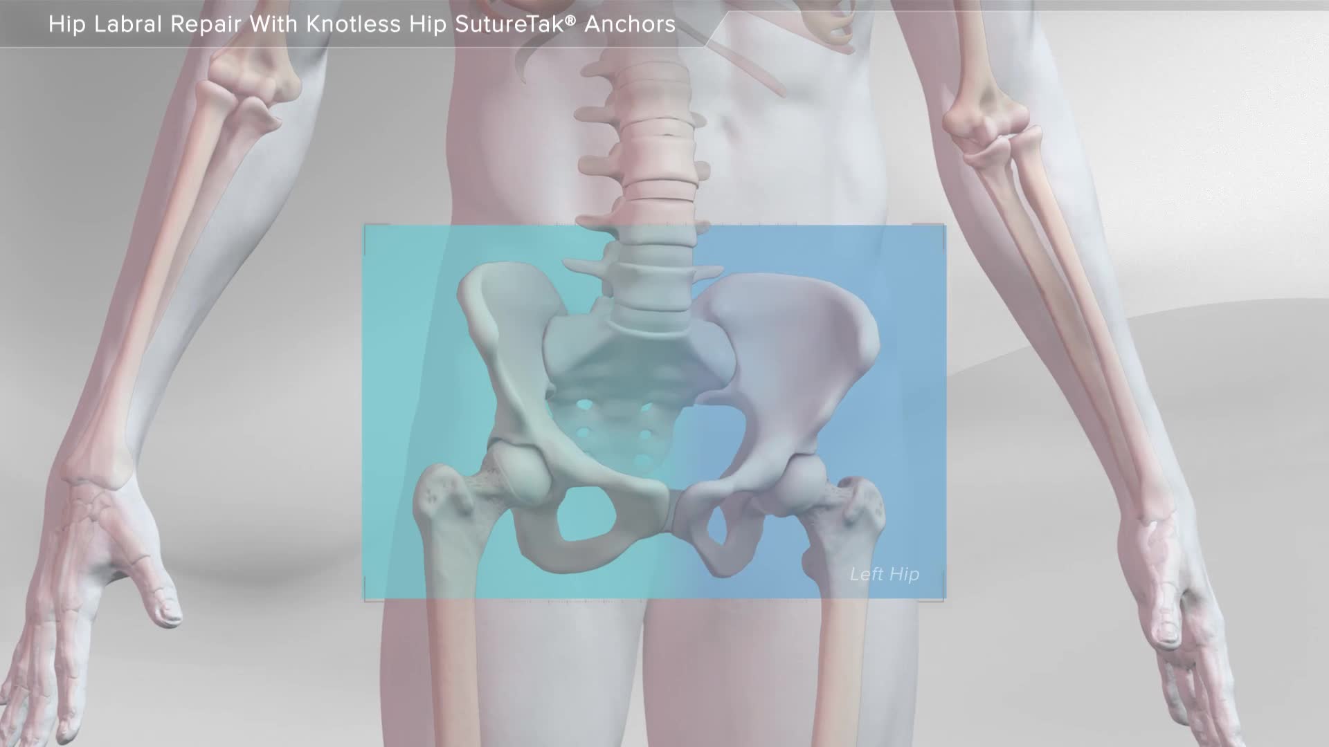Arthrex Hip Labral Repair With Knotless Hip Suturetak® Anchors
