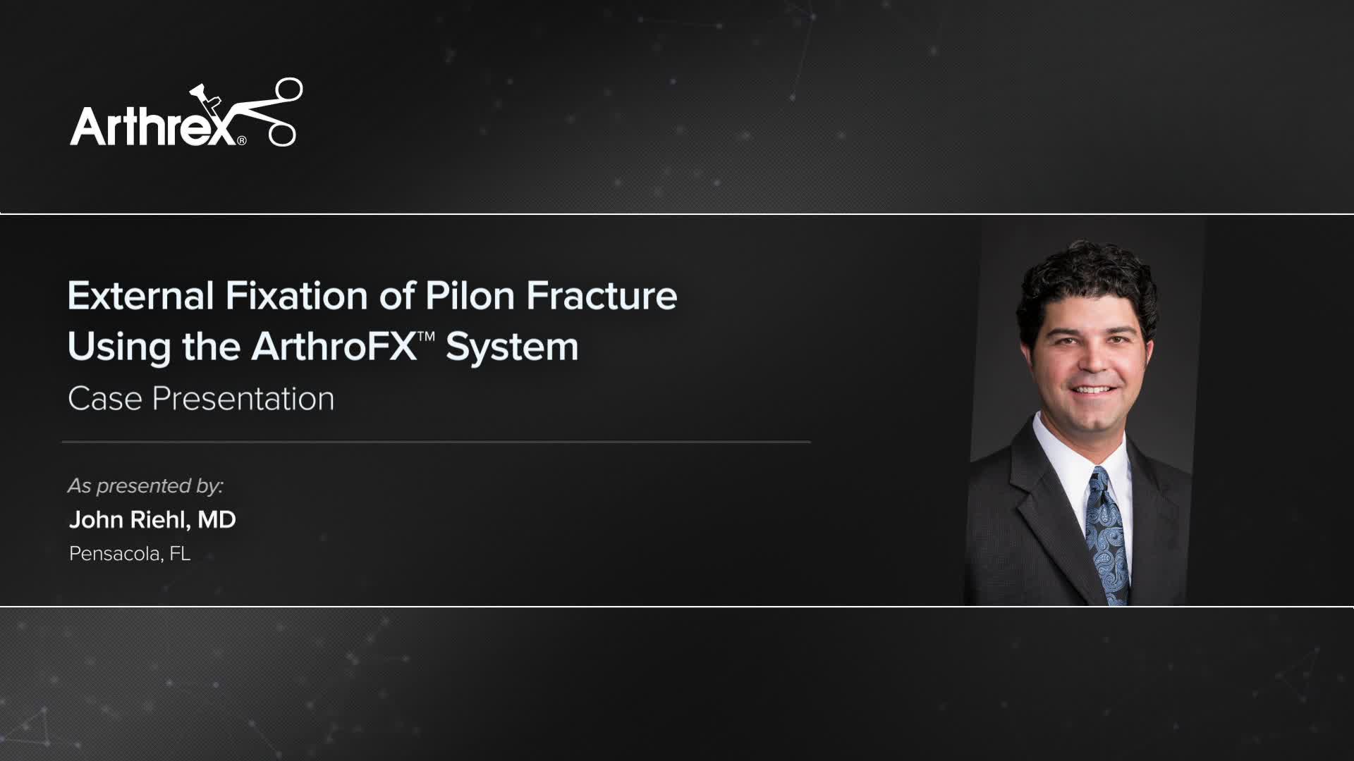 Arthrex External Fixation Of Pilon Fracture Using The Arthrofx™ System