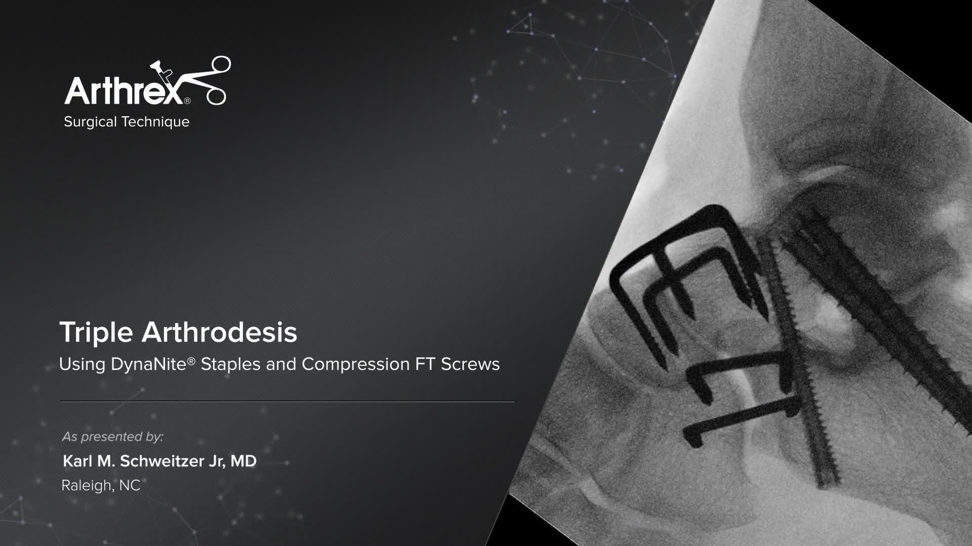 Arthrex Triple Arthrodesis Using Dynanite® Staples And Compression Ft Screws