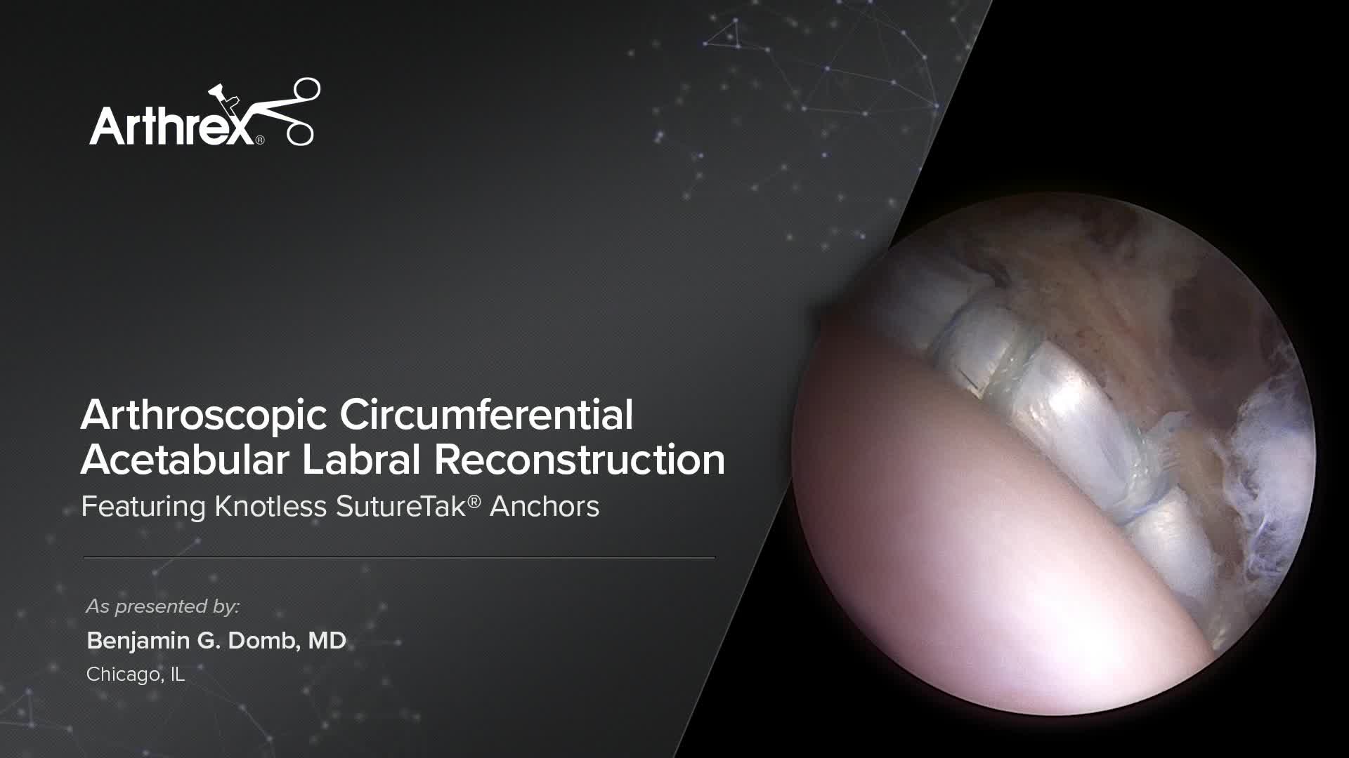 Arthrex Arthroscopic Circumferential Acetabular Labral Reconstruction
