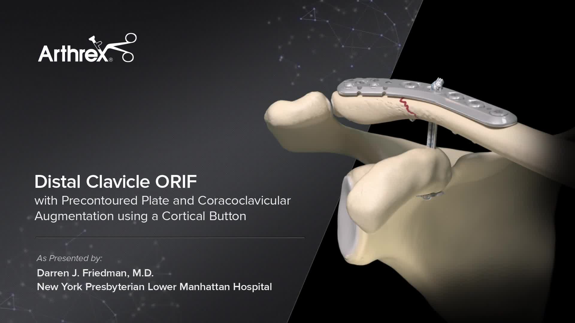 Arthrex Distal Clavicle Orif With Precontoured Plate And
