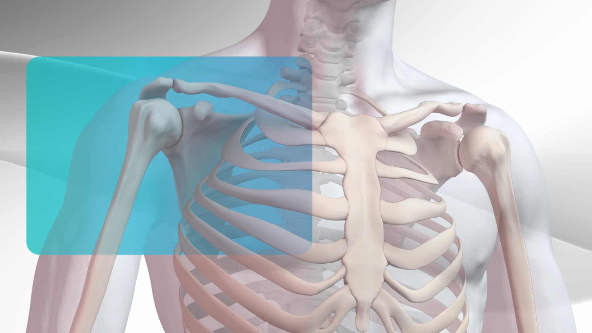 Arthrex - Univers Revers™ Total Shoulder System Arthrex - Univers Revers™ Total Shoulder System